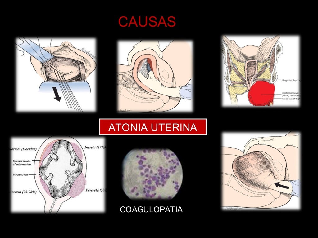 Hemorragia Pos Parto Tardia - BRAINCP