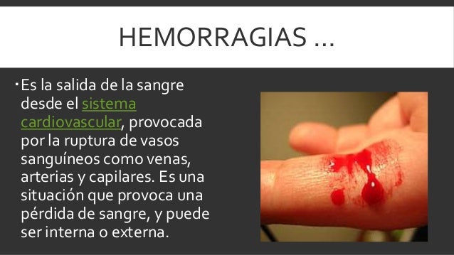 Hemorragia Externa