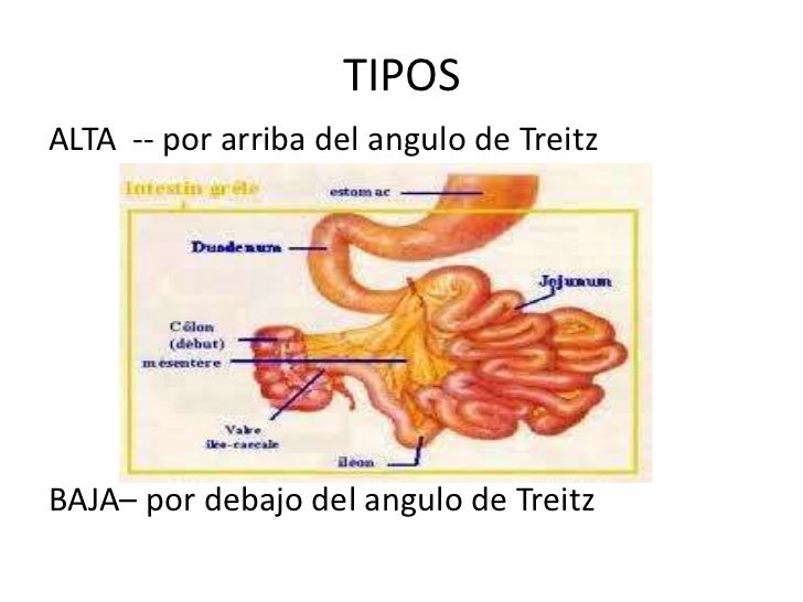 Ligamento De Treitz