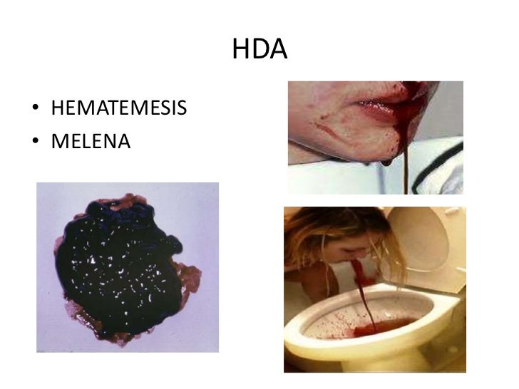 Hemorragias digestivas