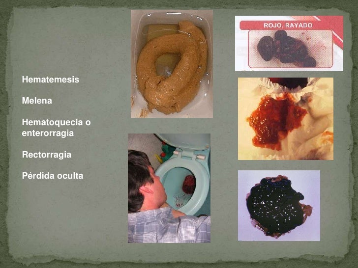 Hemorragias gastrointestinales