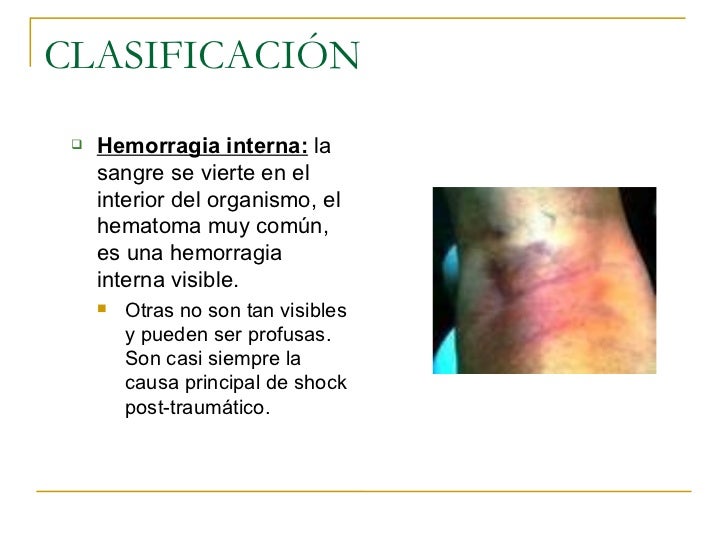 Hemorragia Interna Patologia: HEMORRAGIA/ HEMORRAGIA POR REXE/