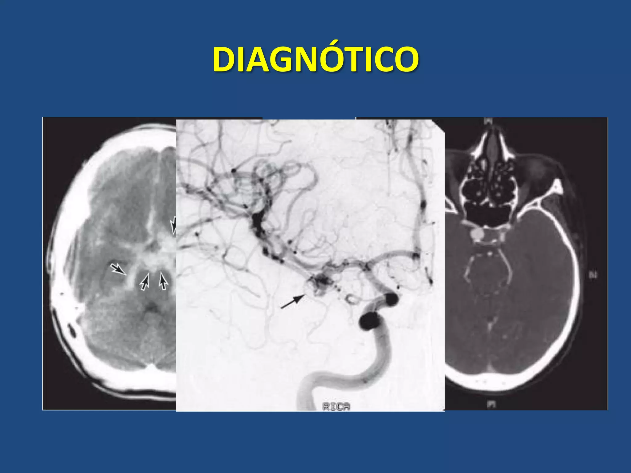 Hemorragia subaracnoidea