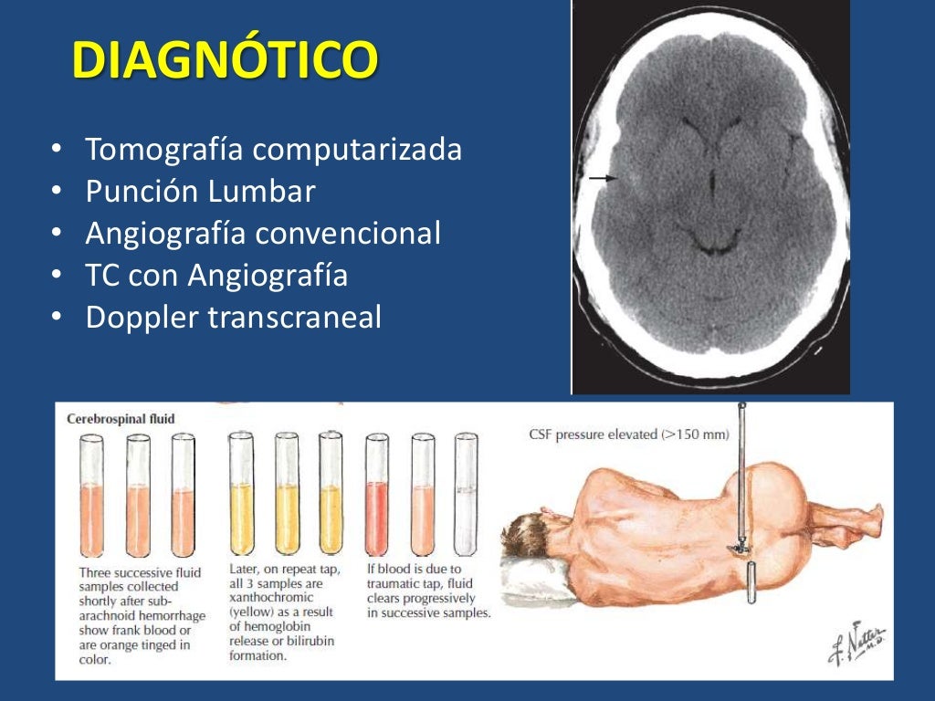 Hemorragia subaracnoidea