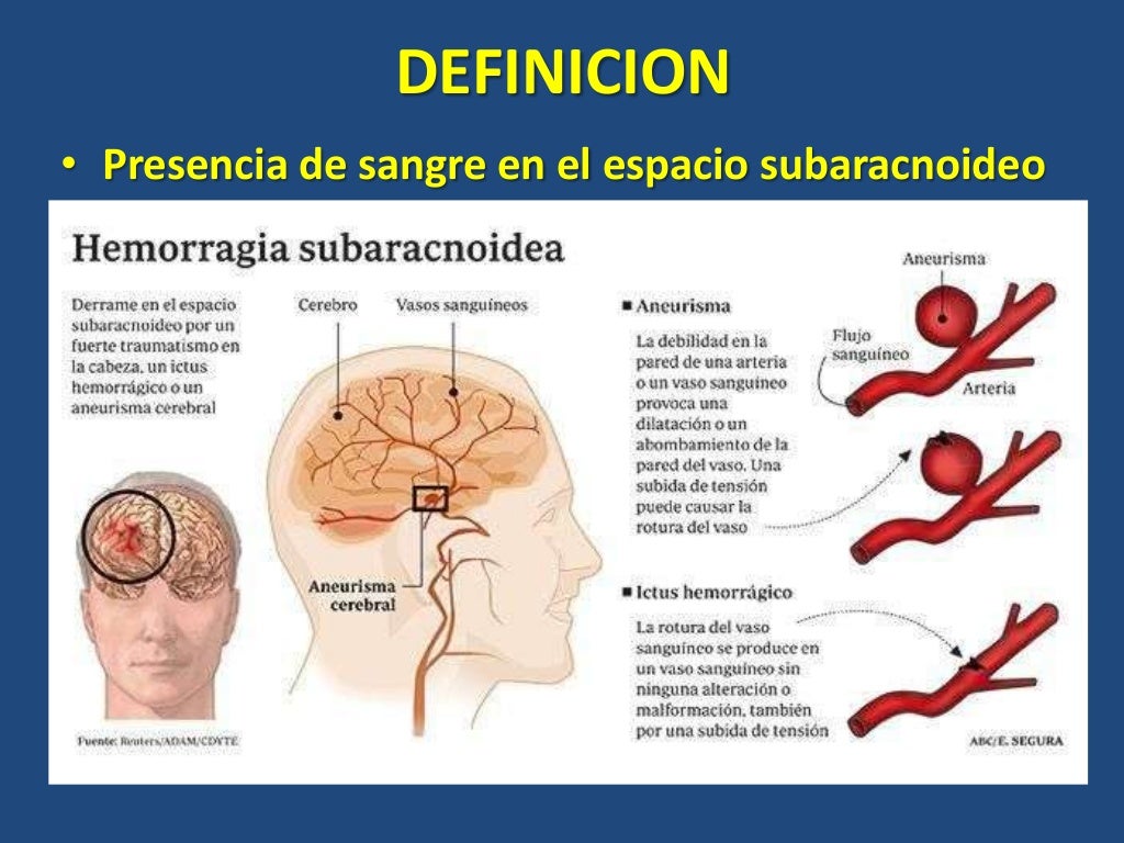 Hemorragia subaracnoidea