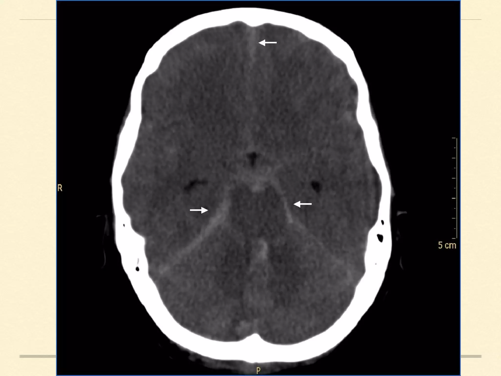 Hemorragia subaracnoidea