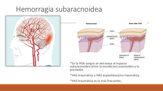 Hemorragia subaracnoidea