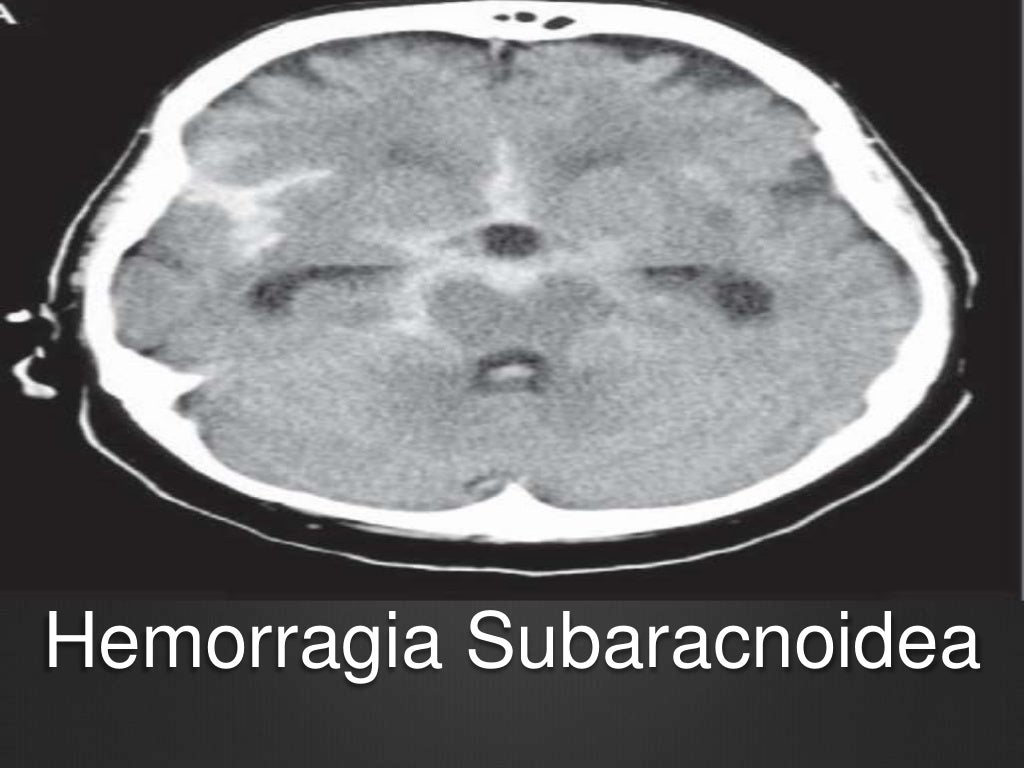 Hemorragia subaracnoidea