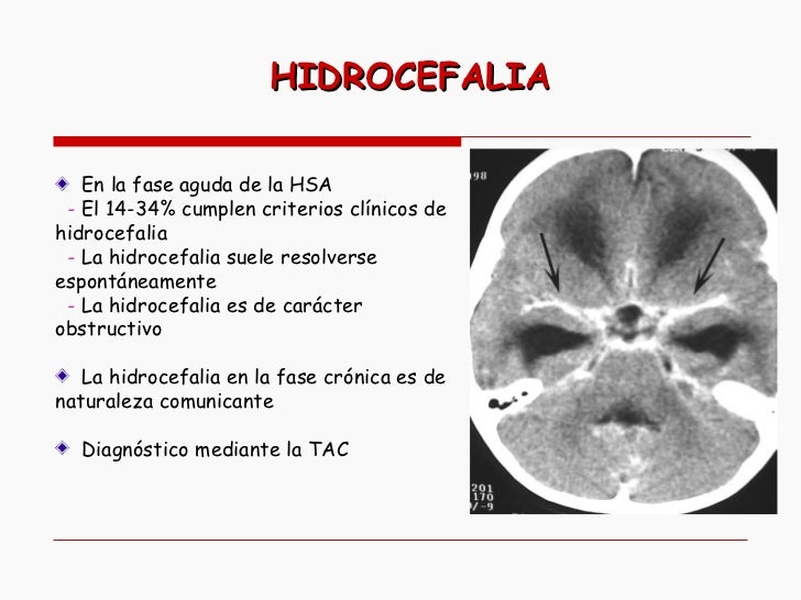 Hemorragia Subaracnoidea