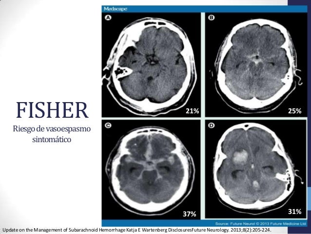 Hemorragia Subaracnoidea Hemorragia Subaracnoidea Cisternas Y Cisuras
