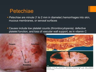 Hemorrhage | PPT