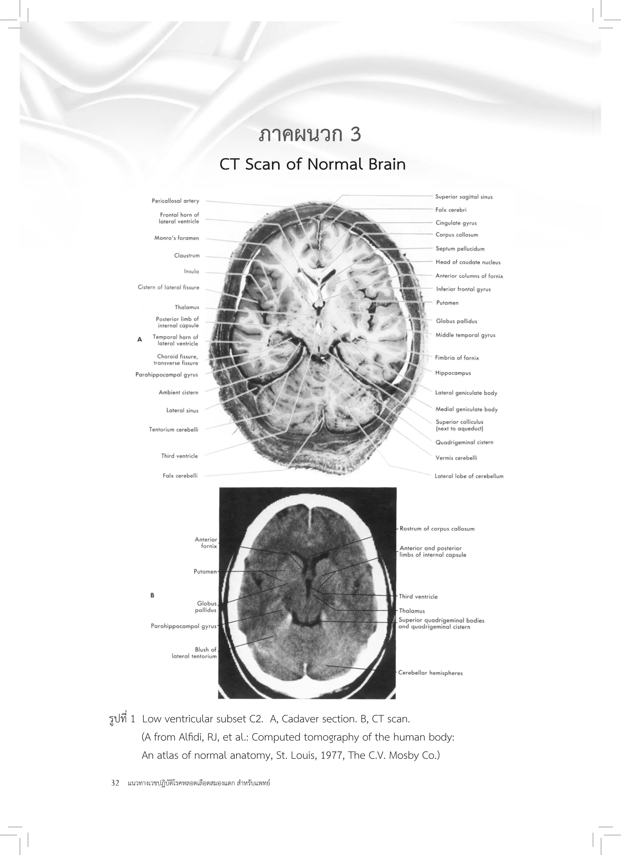 CPG Thai hemorrhagic stroke 2551 | PDF