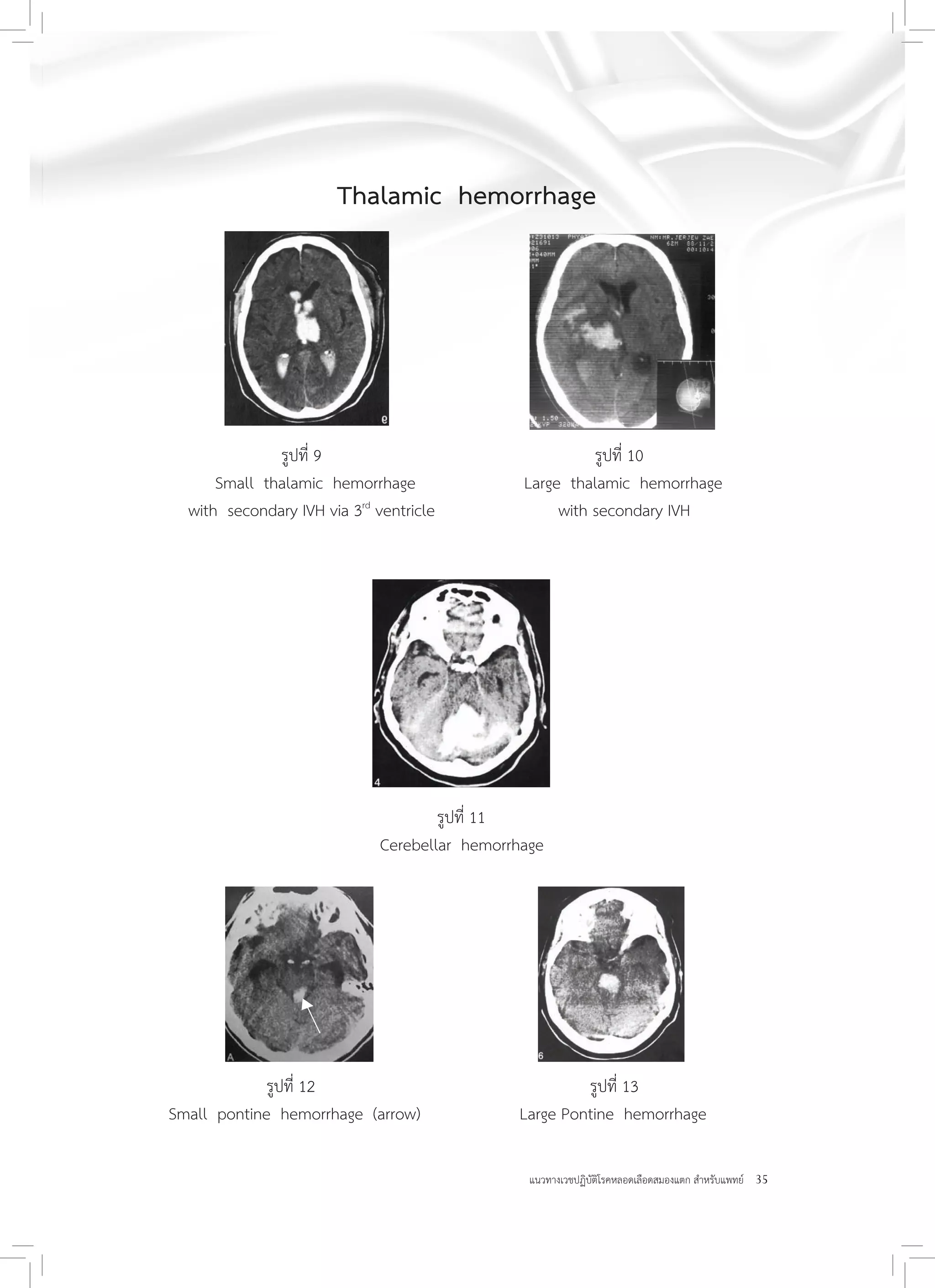 CPG Thai hemorrhagic stroke 2551 | PDF