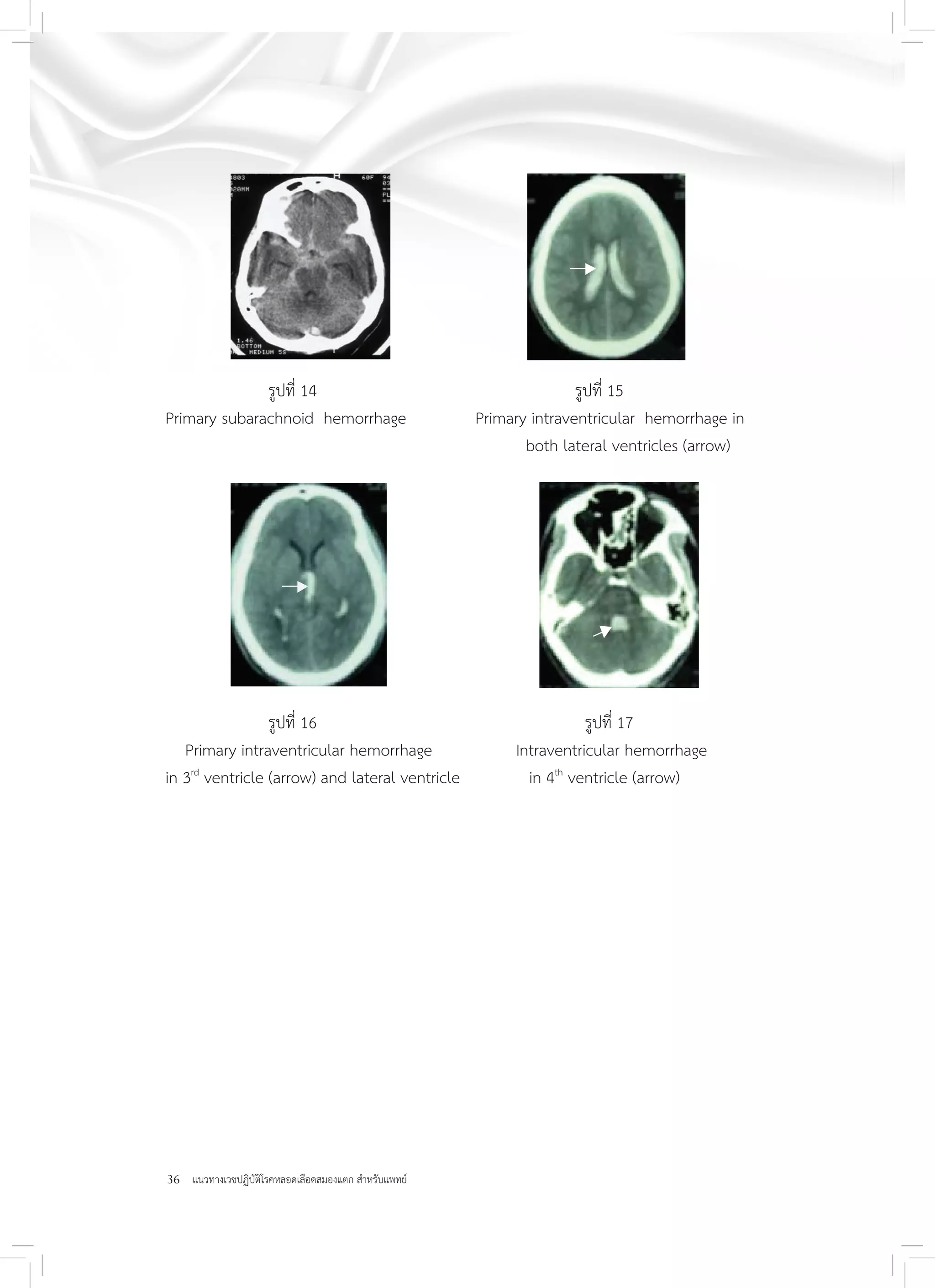 CPG Thai hemorrhagic stroke 2551 | PDF