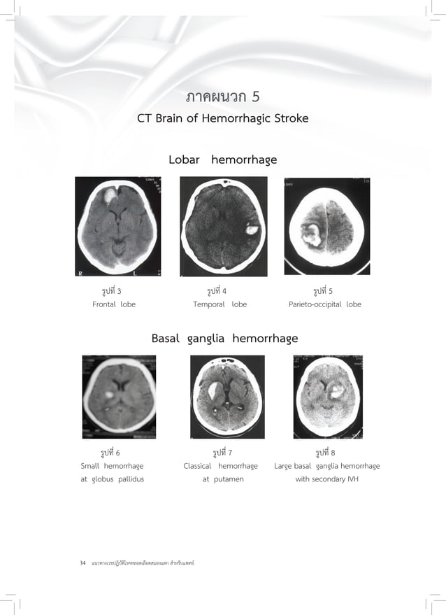 CPG Thai hemorrhagic stroke 2551 | PDF