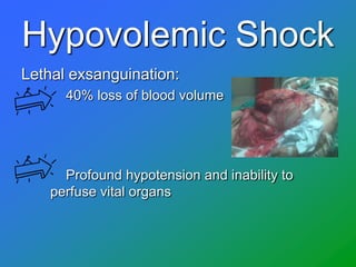 Hemorrhagic shock | PPT