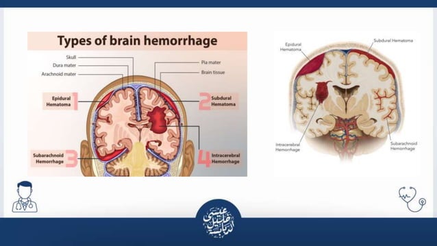Hemorrhagic Stroke.pptx