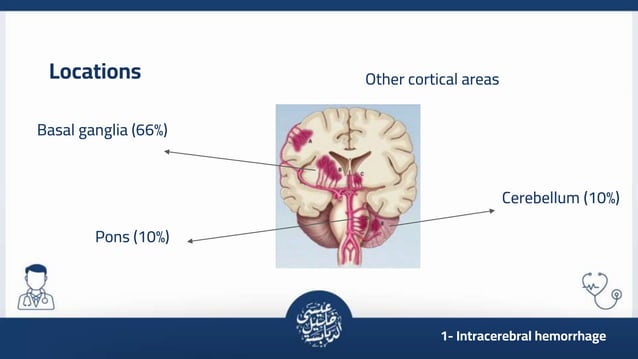 Hemorrhagic Stroke.pptx