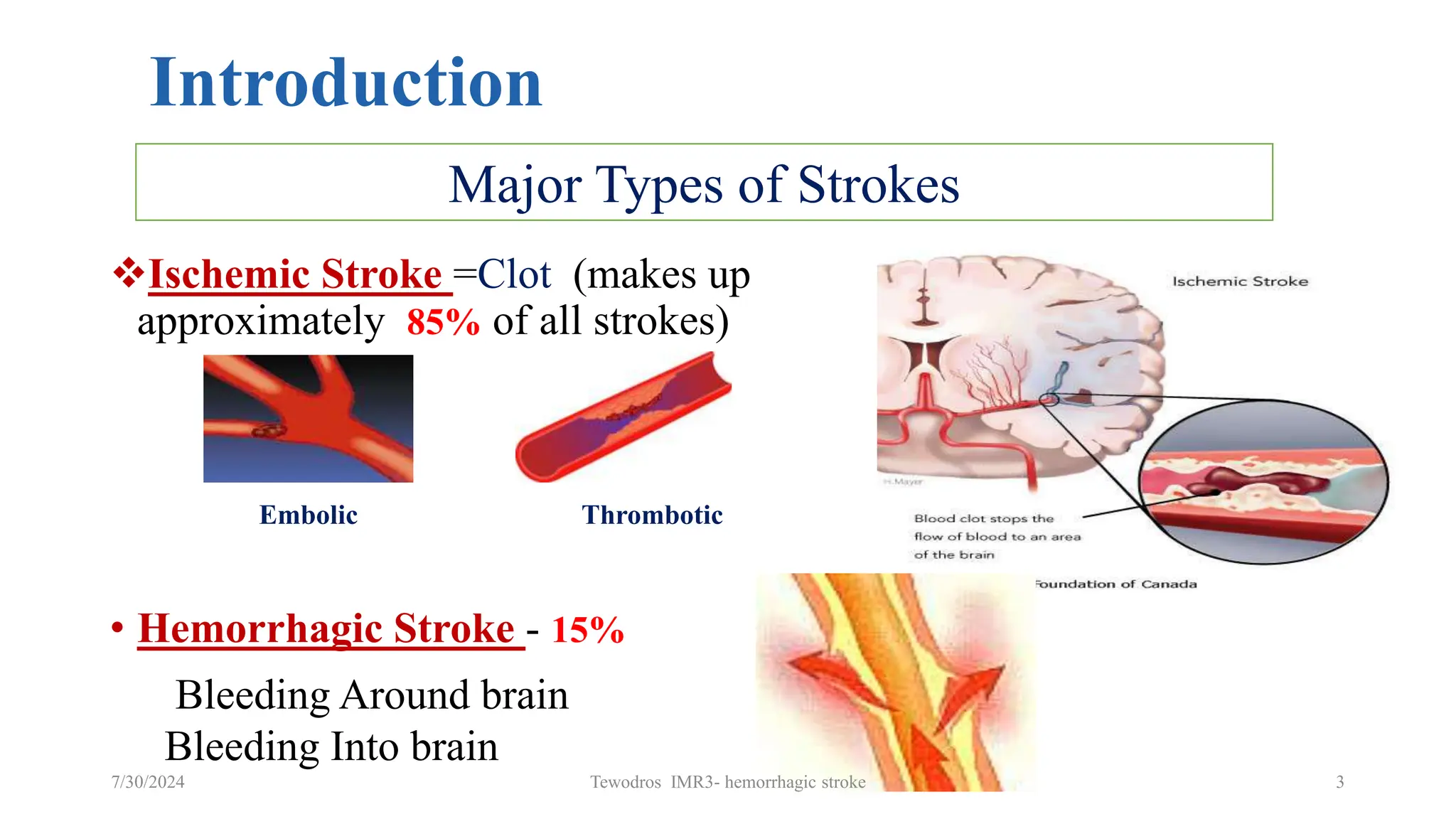 causes and management of hemorrhagic stroke | PPTX
