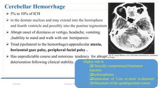 causes and management of hemorrhagic stroke | PPTX