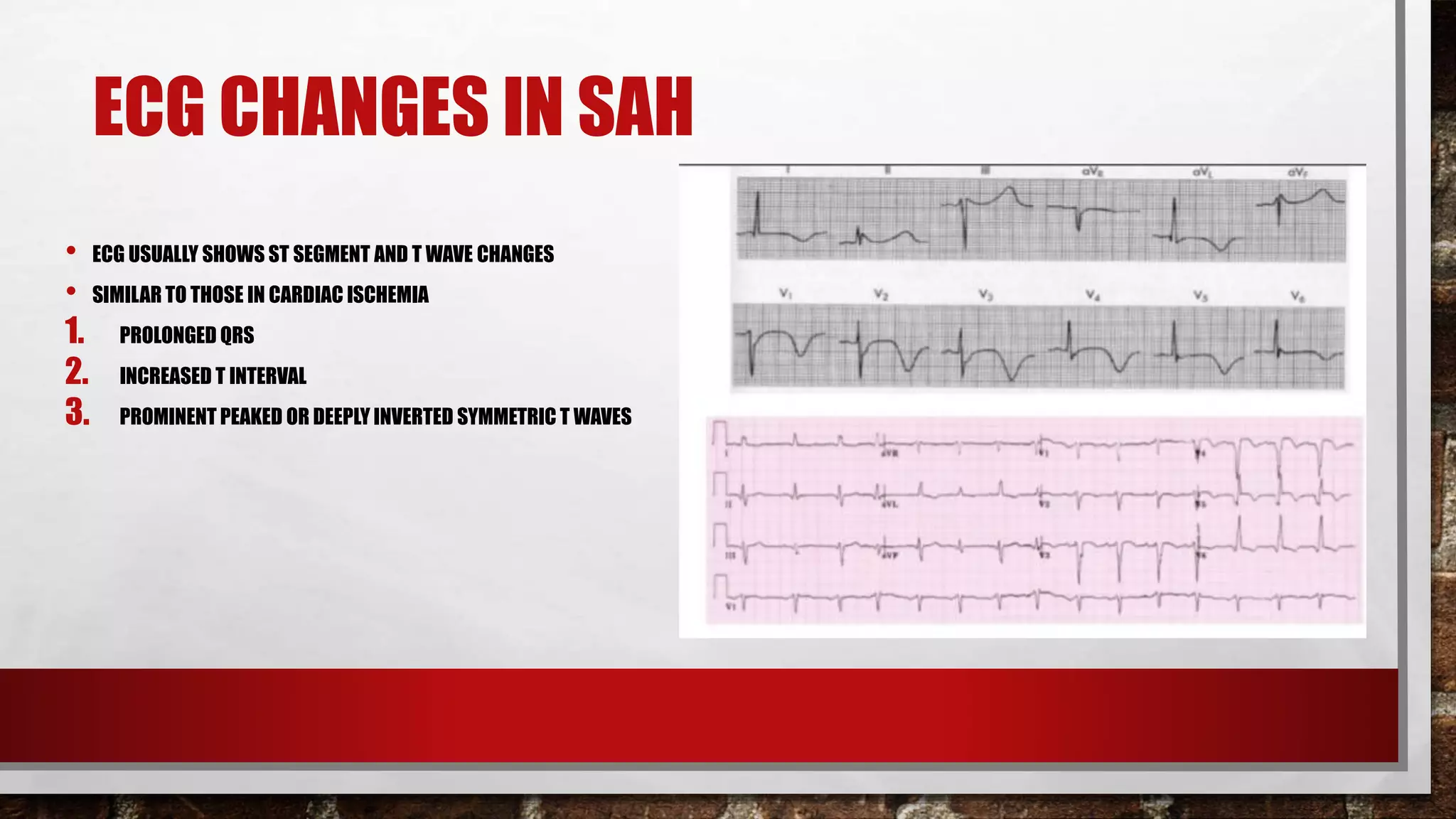 Hemorrhagic strokes ,Subarachnoid and Intrracerebral | PPTX