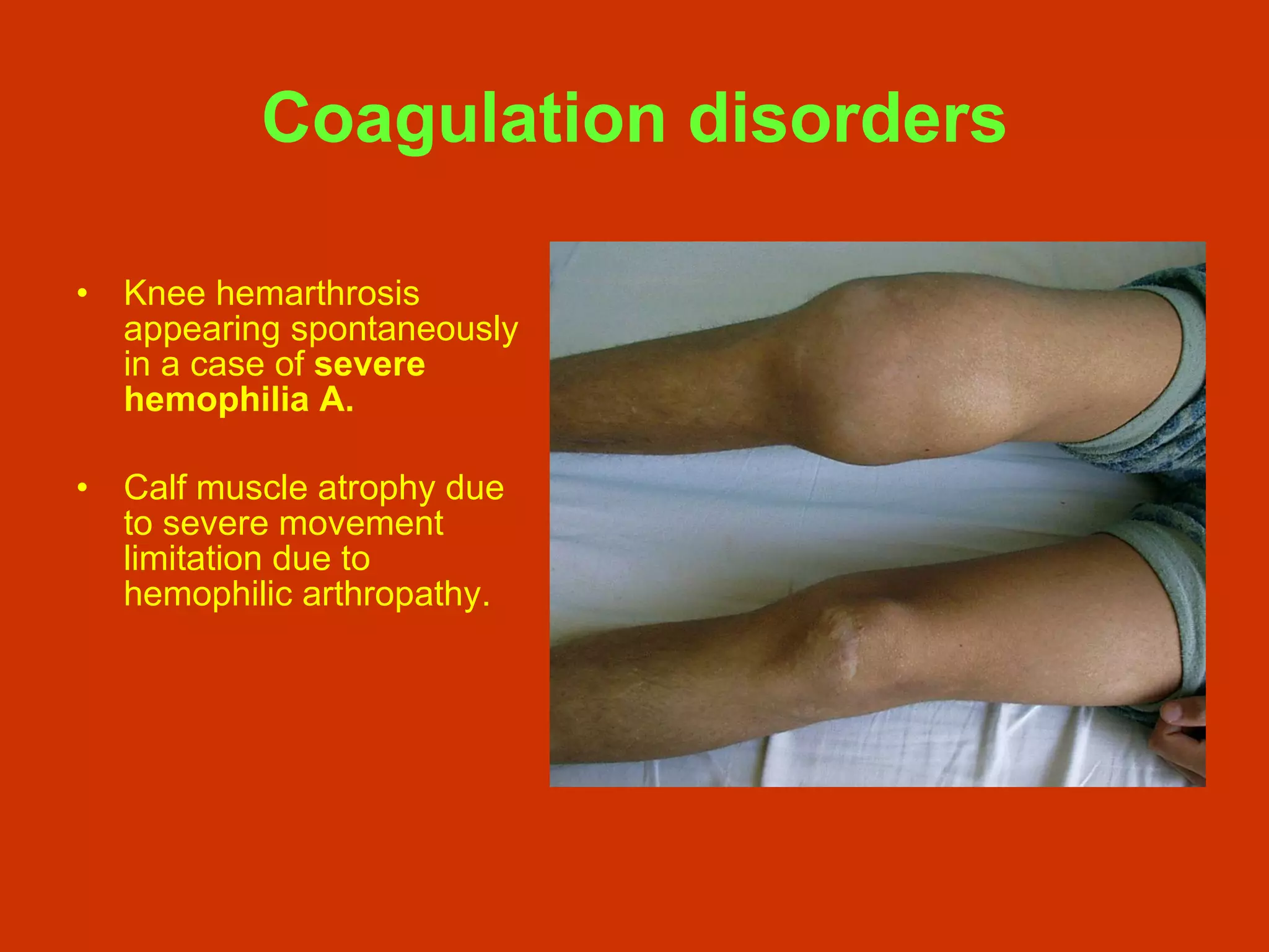 Hemorrhagic Syndromes | PPT