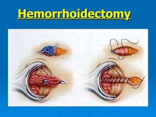 Hemorrhoid | PPT