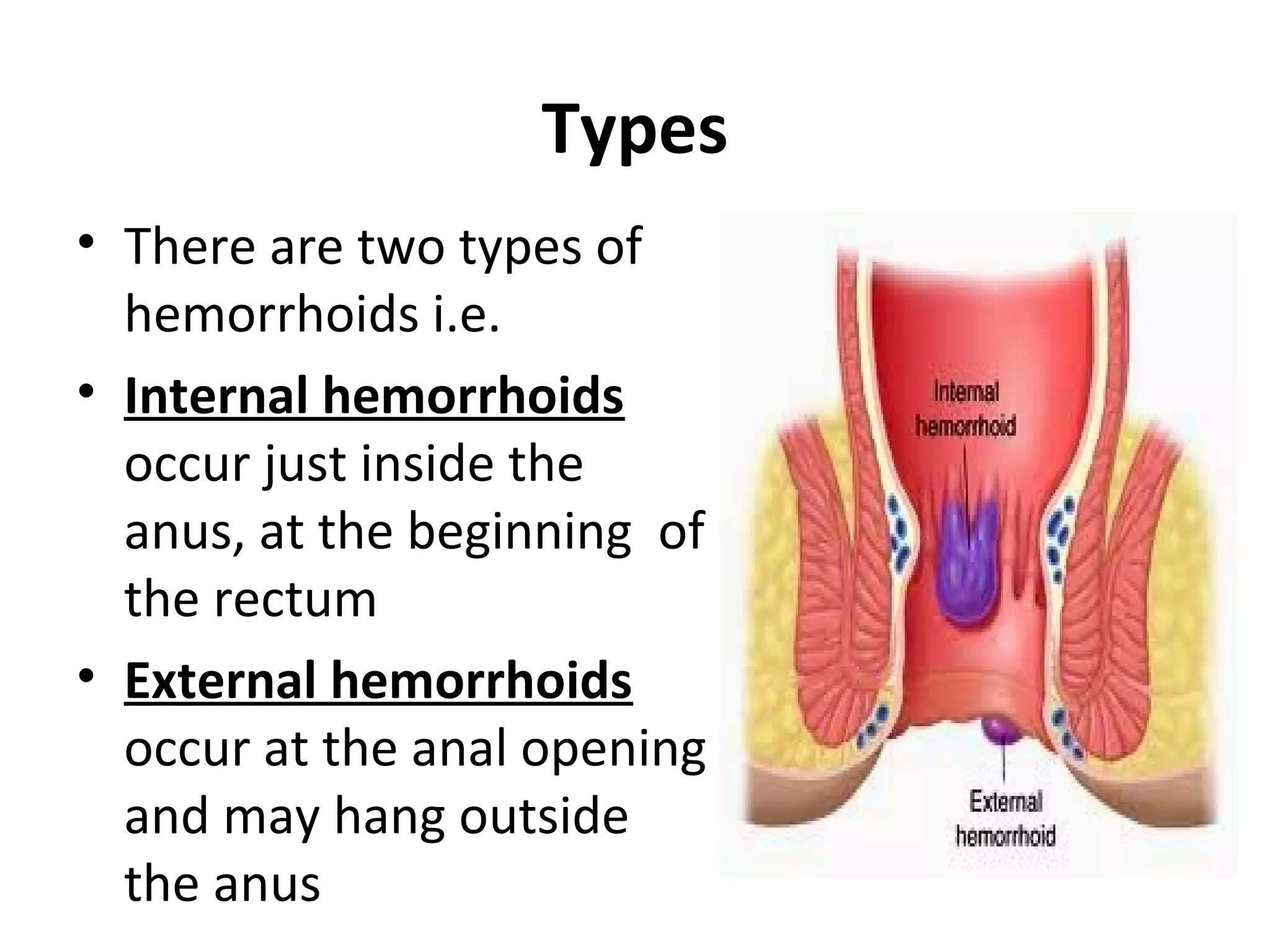 Hemorrhoid 161023041010 | PPT