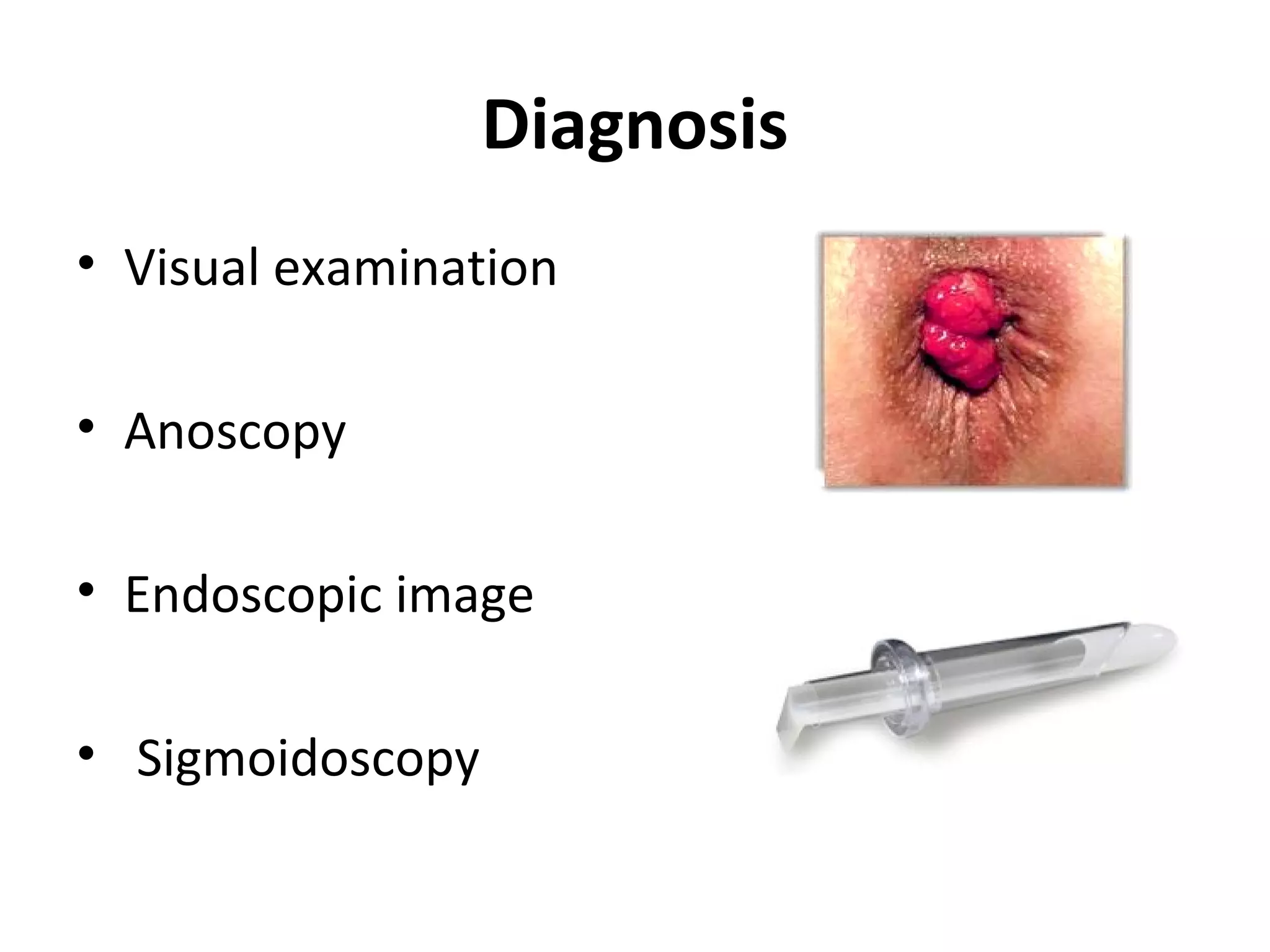 Hemorrhoid 161023041010 | PPT