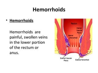 Hemorrhoid 161023041010 | PPT