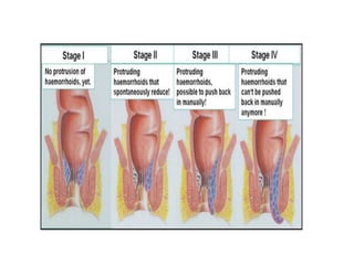 Hemorrhoid | PPTX