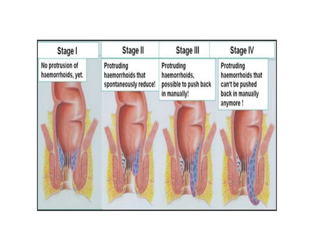 Hemorrhoid | PPTX | Digestive Disorders | Diseases and Conditions
