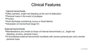 Hemorrhoids | PPTX