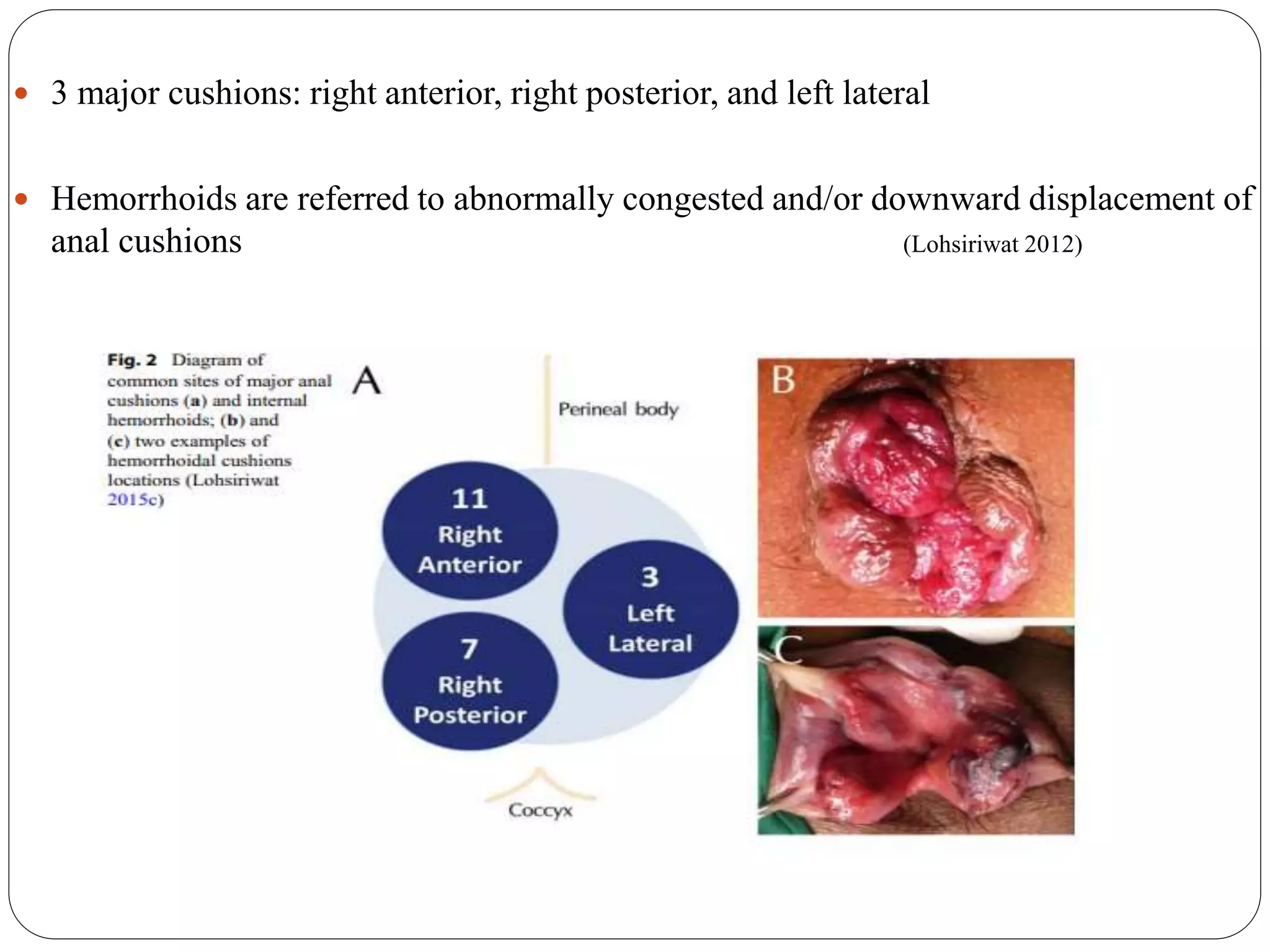 Hemorrhoidal Disease Ppt