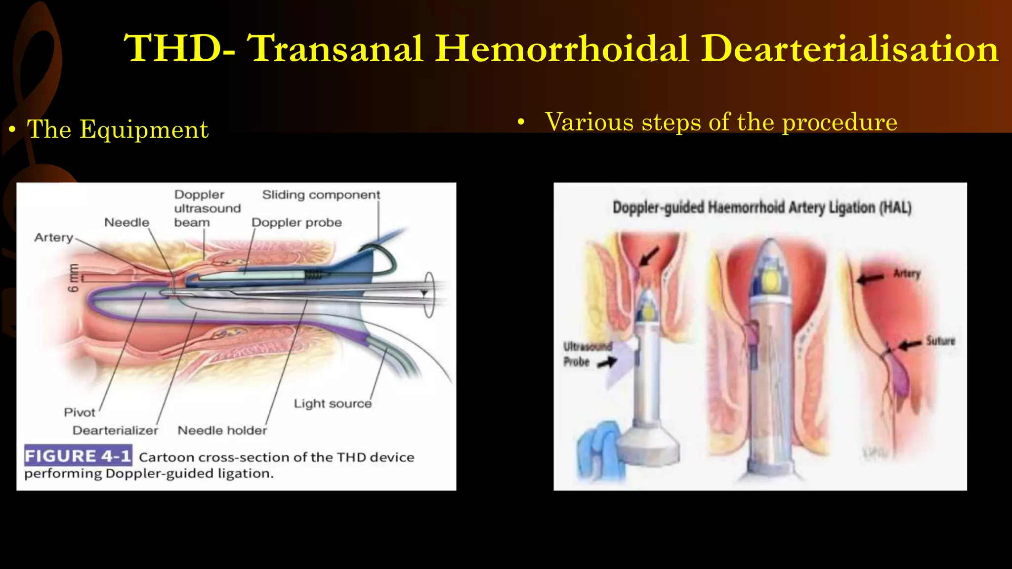 Hemorrhoidectomy/ operative surgery | PPTX