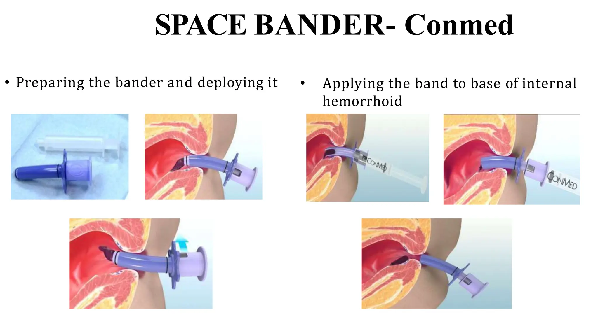 Hemorrhoidectomy Surgical Procedure Raf Pptx Digestive Disorders
