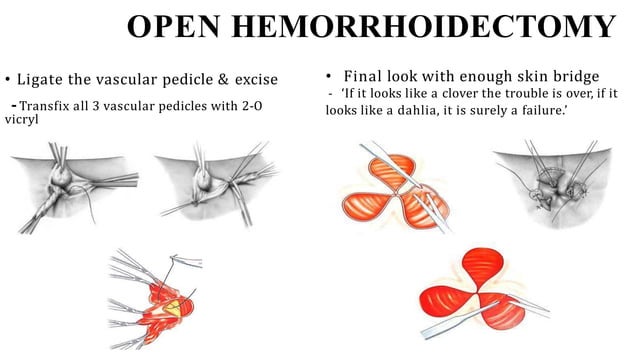 Hemorrhoidectomy surgical procedure RAF.pptx | Digestive Disorders ...