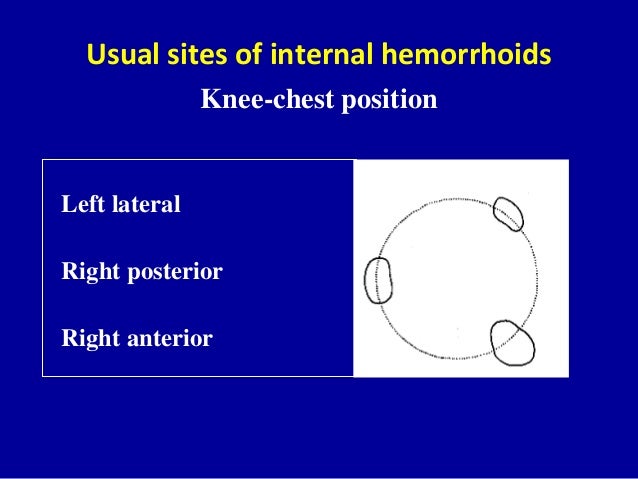 Hemorrhoides