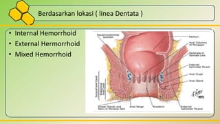 Hemorrhoid ambeyen hemorhoid azis[1].pptx