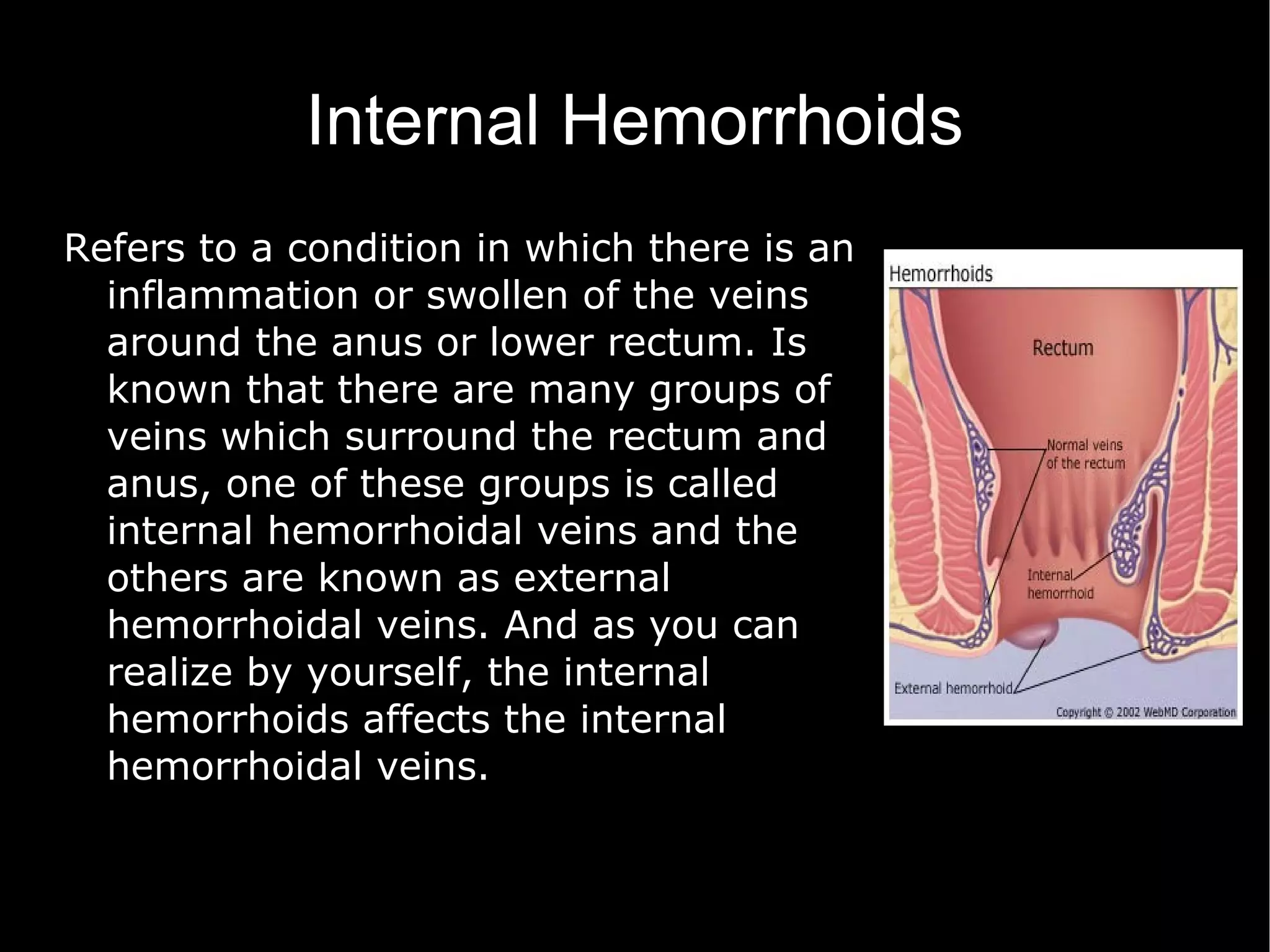 Hemorrhoids 1235093240420575 1 | PPT