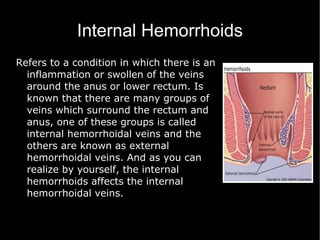 Hemorrhoids 1235093240420575 1