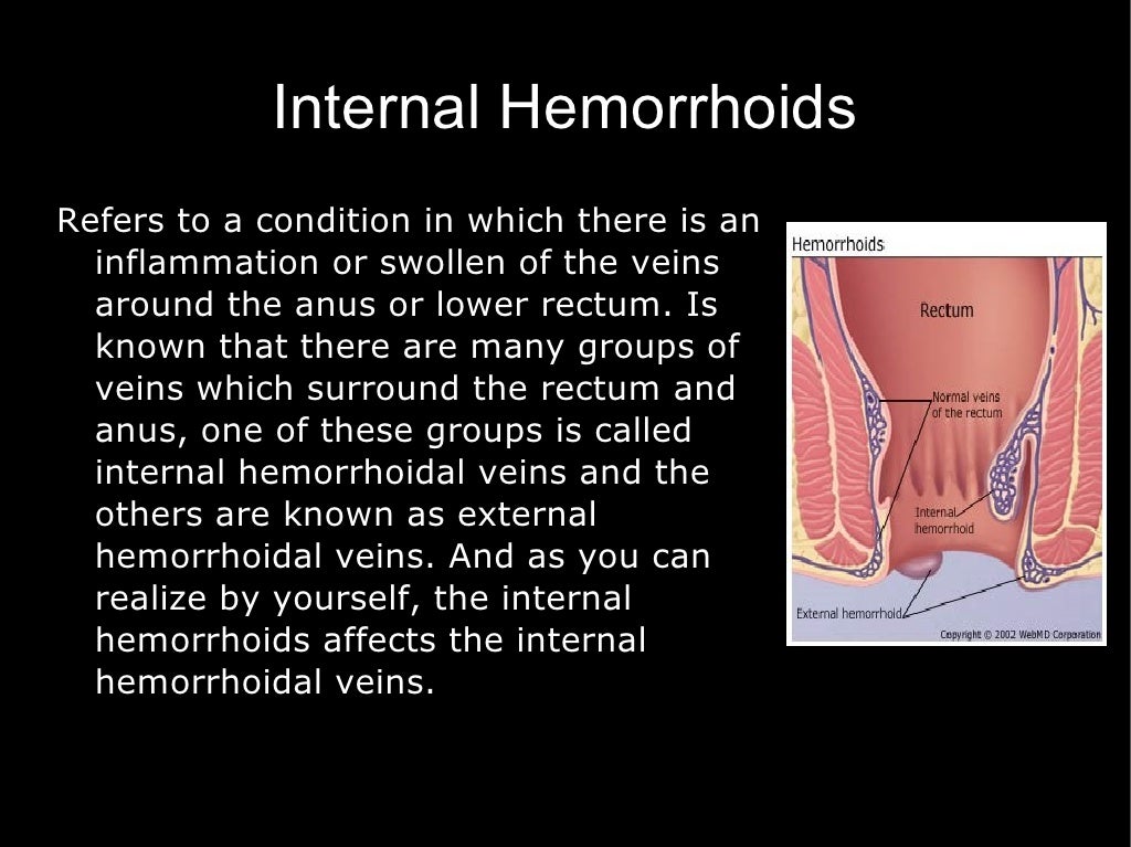 Hemorrhoids 1235093240420575 1
