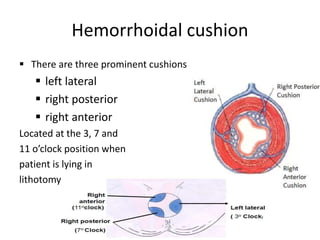 Hemorrhoids | PPT