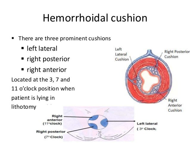 Hemorrhoids