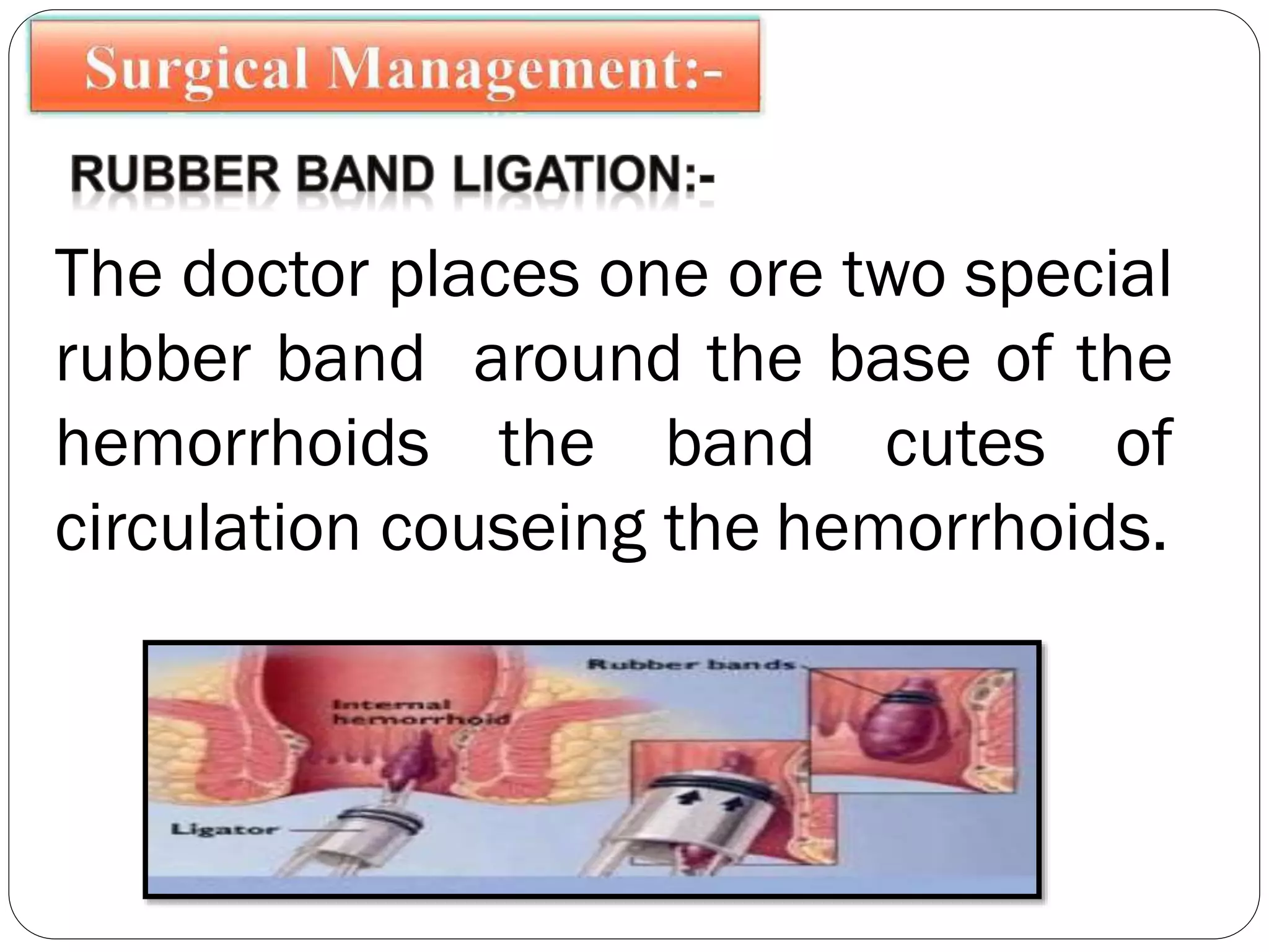 Hemorrhoids ppt | PPTX