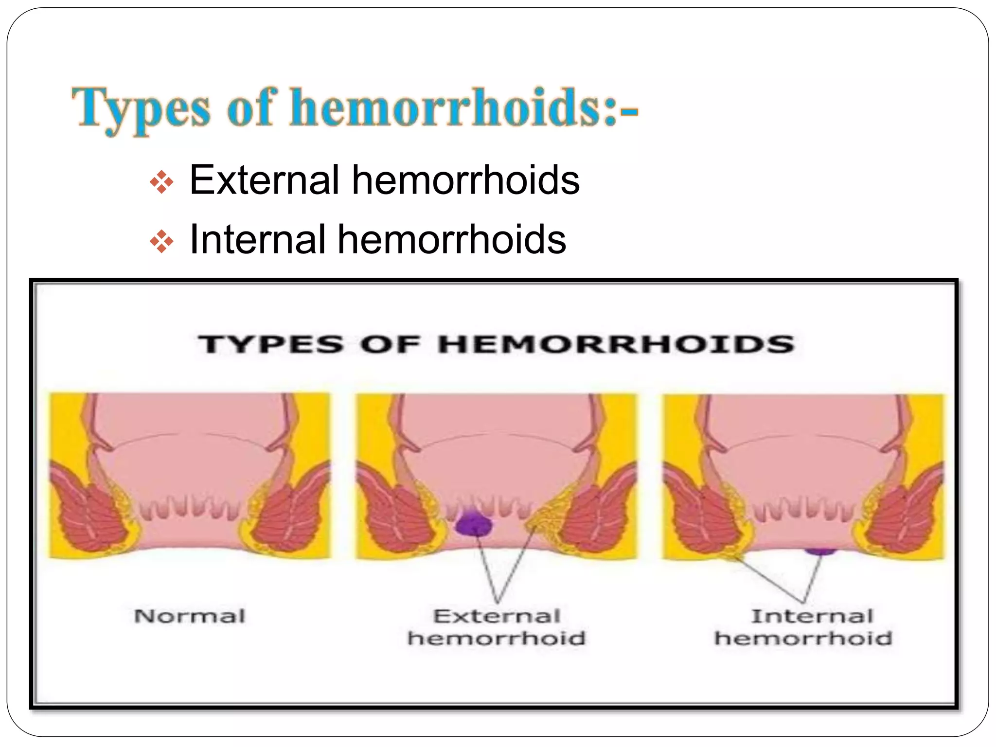 Hemorrhoids ppt | PPTX