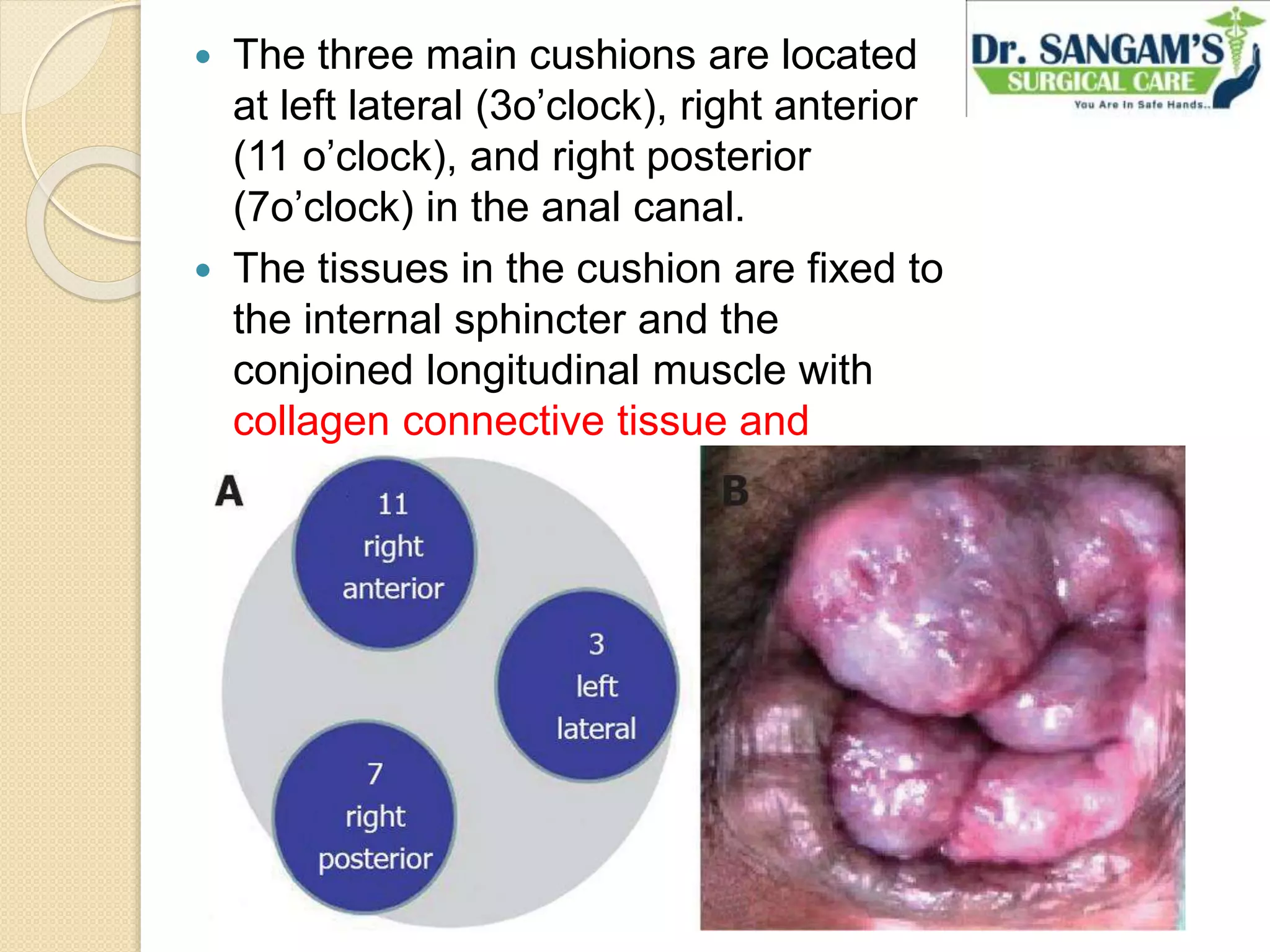 Hemorrhoids - Piles | PPTX