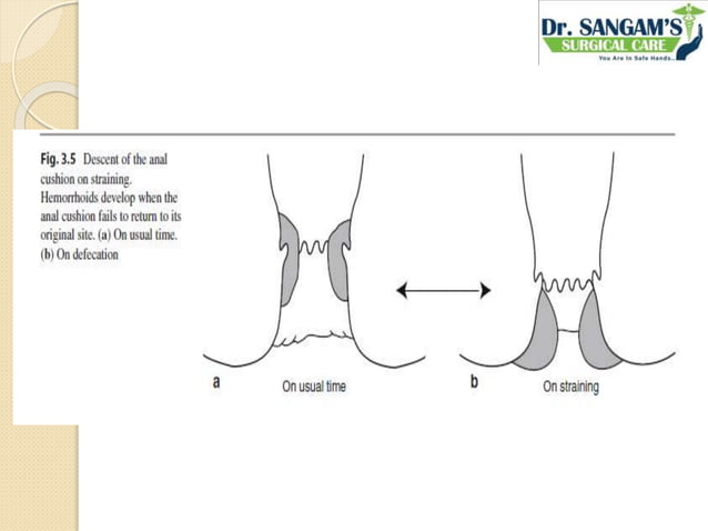 Hemorrhoids - Piles | PPTX | Digestive Disorders | Diseases and Conditions