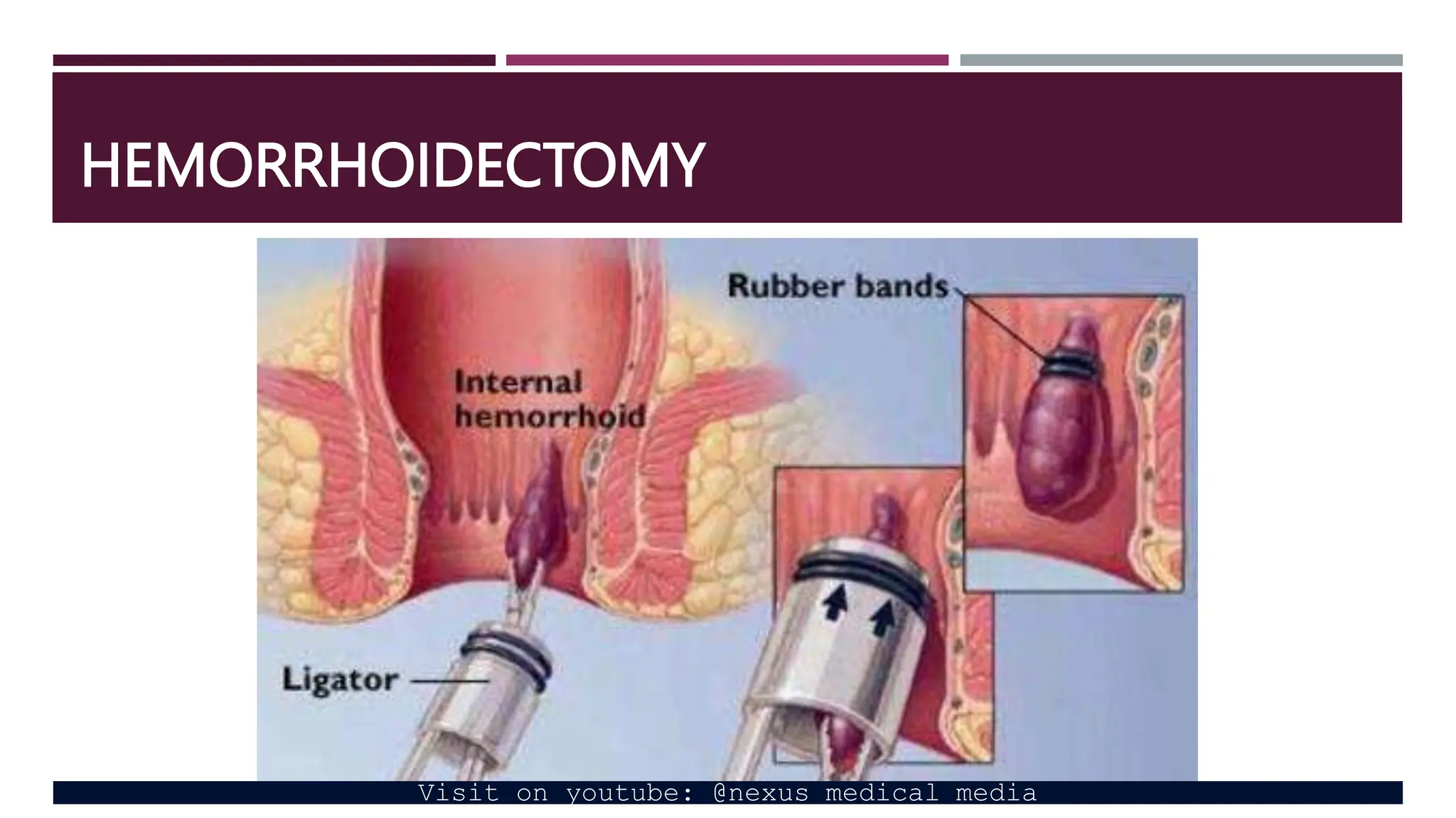 Hemorrhoids Anatomy Pathophysiology Clinical Features Diagnosis And