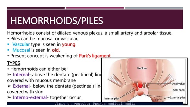 Hemorrhoids Anatomy Pathophysiology Clinical Features Diagnosis And